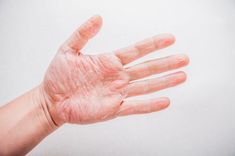 Etude sur l'eczéma chronique des mains