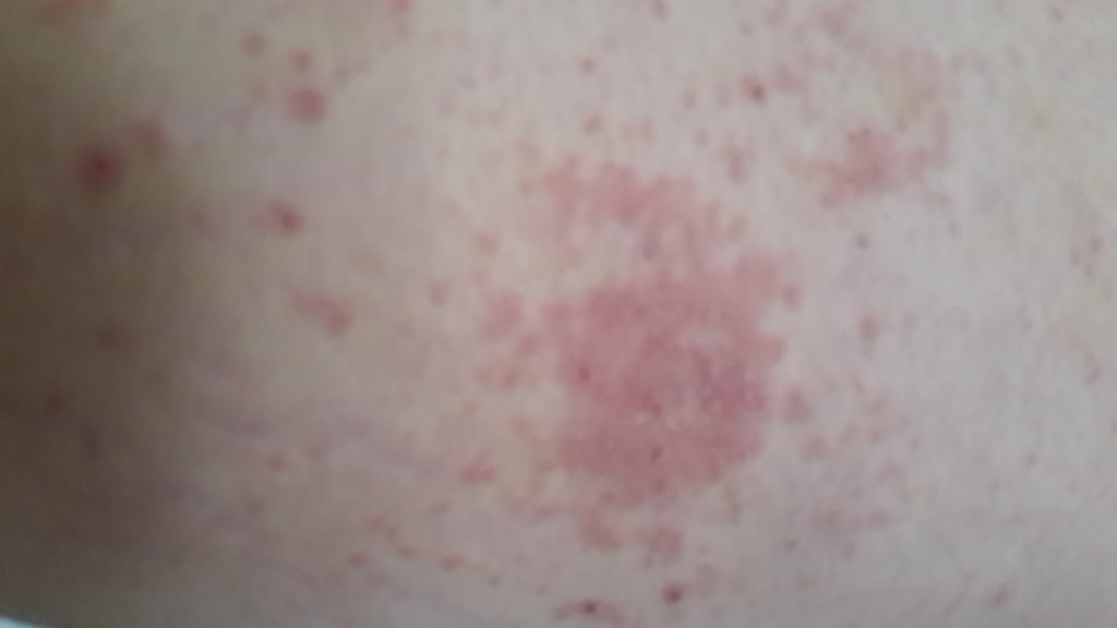 Staphylocoque, qu'est ce que c'est ? On vous explique