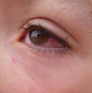 Qu'est ce-que la kératoconjonctivite allergique ? - Association ...