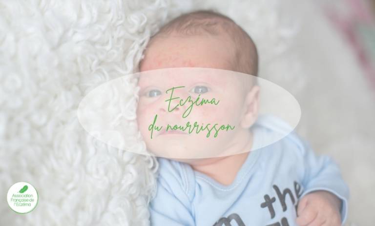 Eczéma du nourrisson - Association Française de l'eczéma