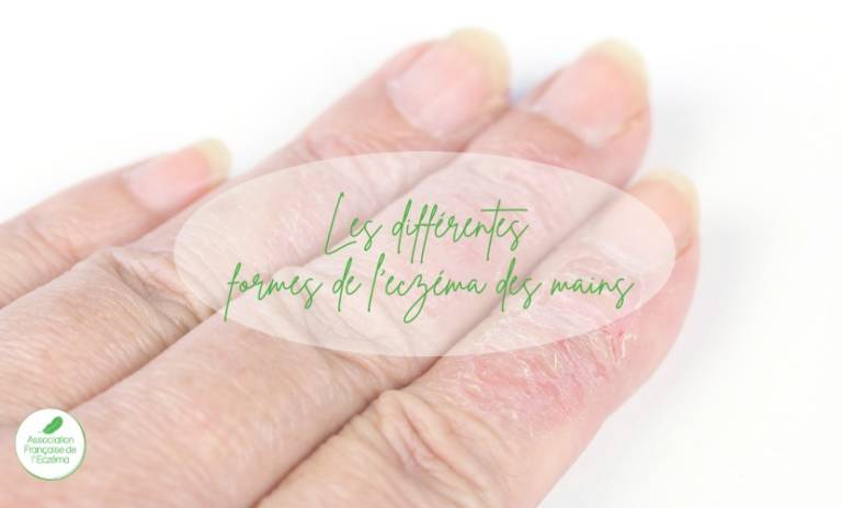 L'eczéma des mains : ses différentes formes, son diagnostic, comment le ...